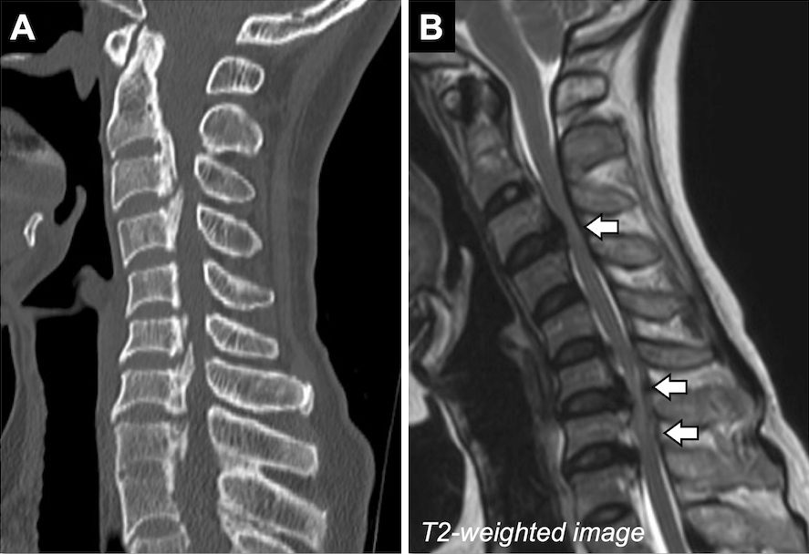 Ossification Of The Posterior Longitudinal Ligament Pathogenesis Hot